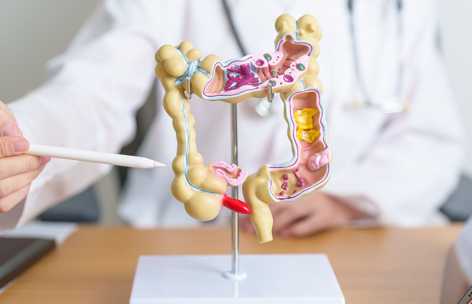 Diète spéciale : Diverticulose et diverticulite - Nutrition - France ...